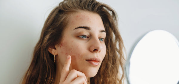 How to Prevent and Heal Acne Scars - Skincare Routine For Healing Acne ...